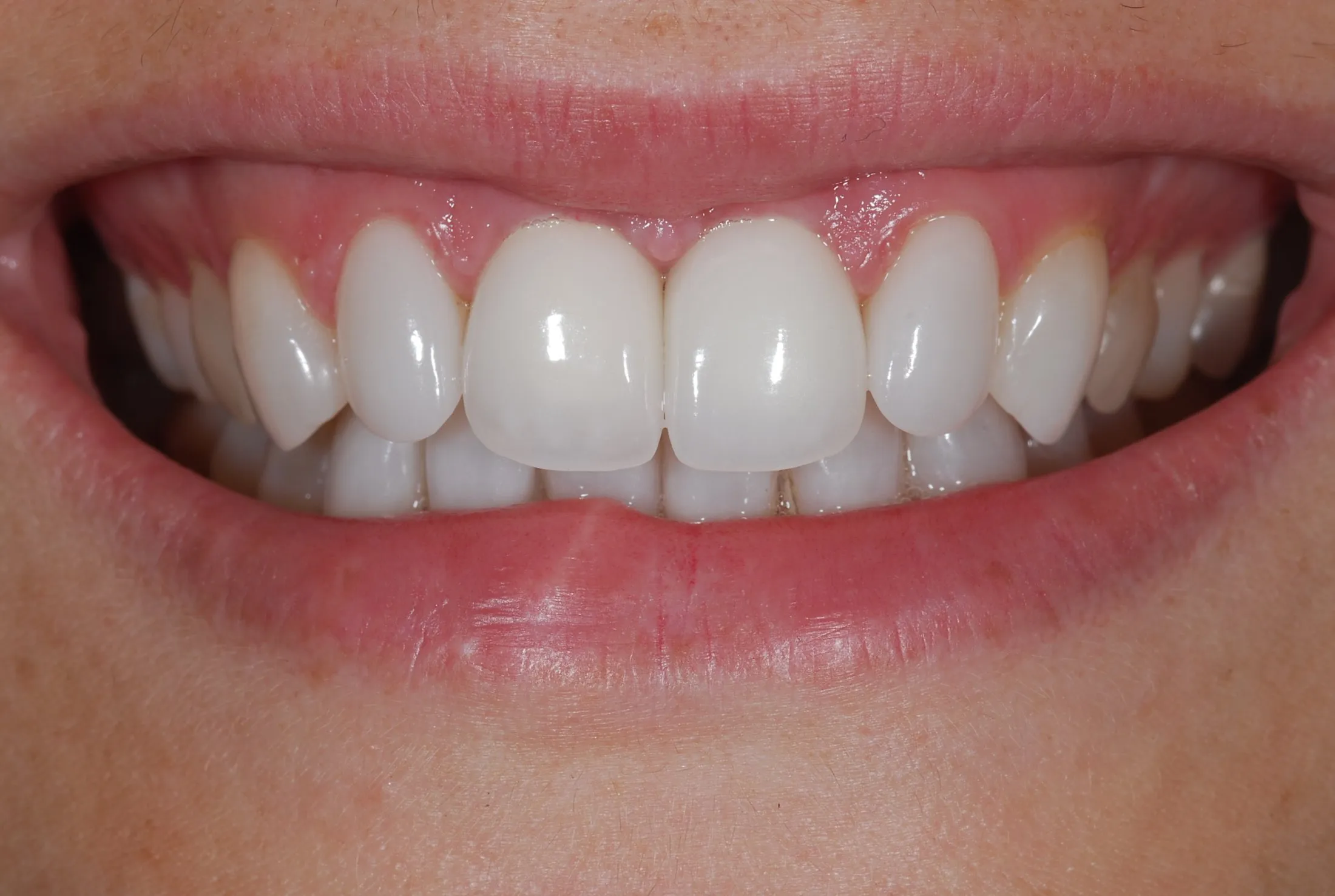 Smile Gallery | Before & After Dental Implants | Scottsdale & Peoria